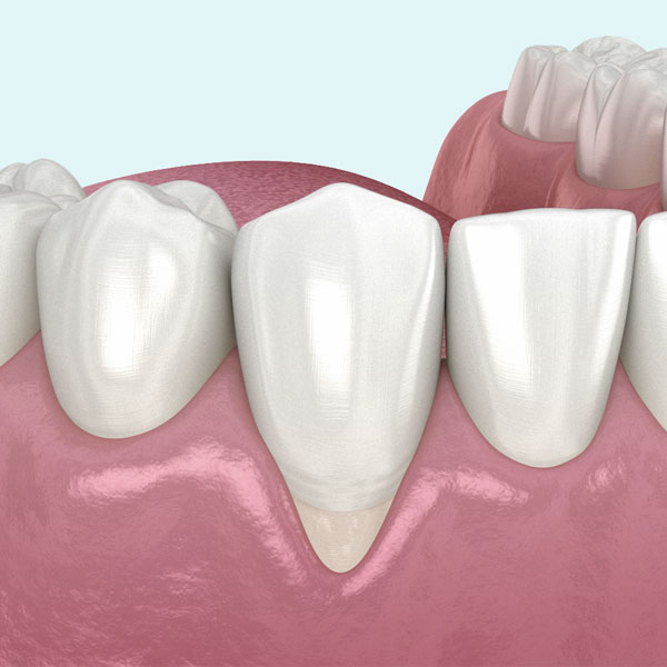 Gum Recession Mythbusters: The Real Culprit Behind Shrinking Gums ...